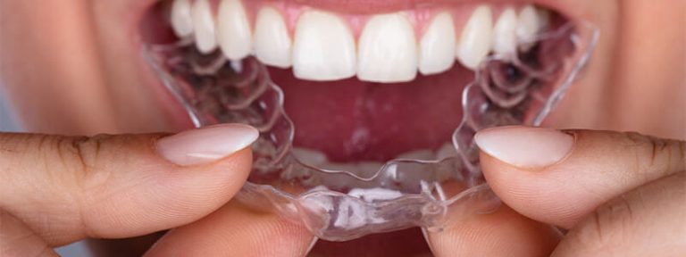 Invisalign Lite: Accelerate Your Journey to a Flawless Smile