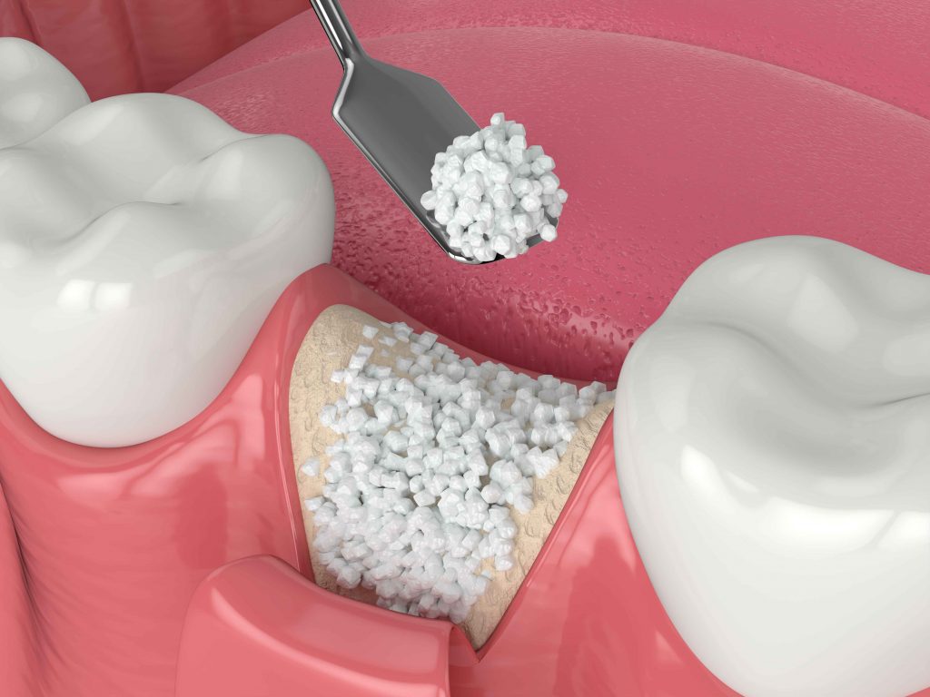 Dental Bone Grafting Augmentation | Metro Dental Clinic