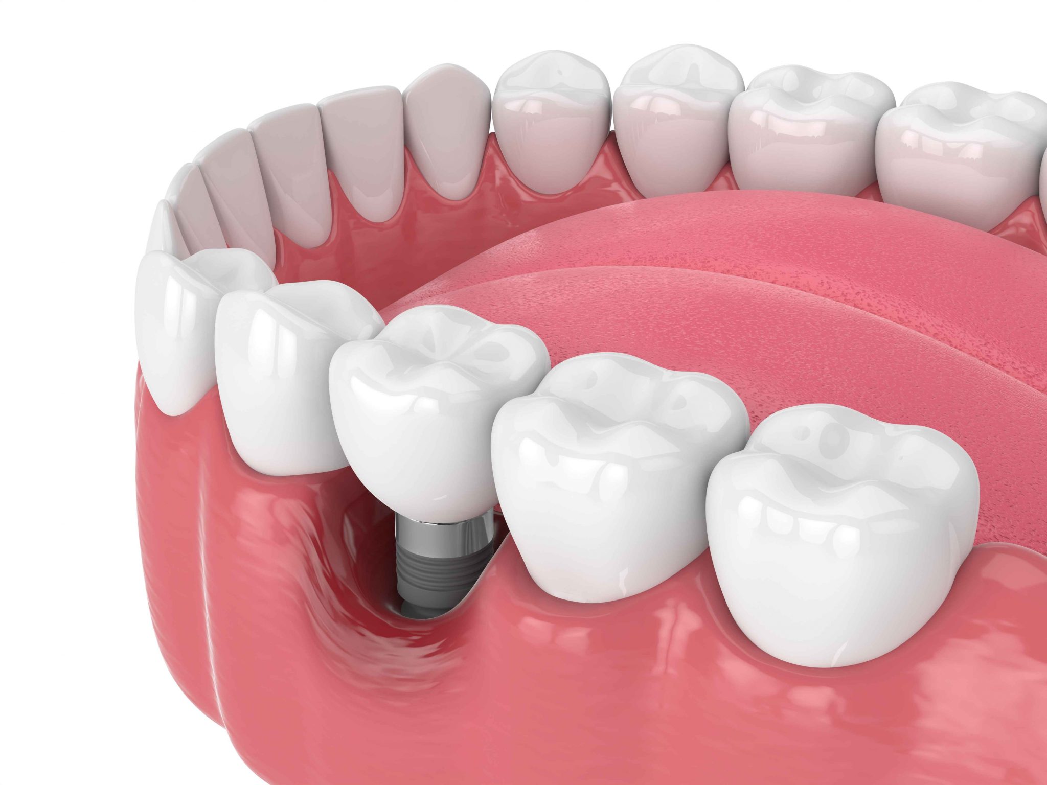 Dental Bone Grafting Augmentation | Metro Dental Clinic