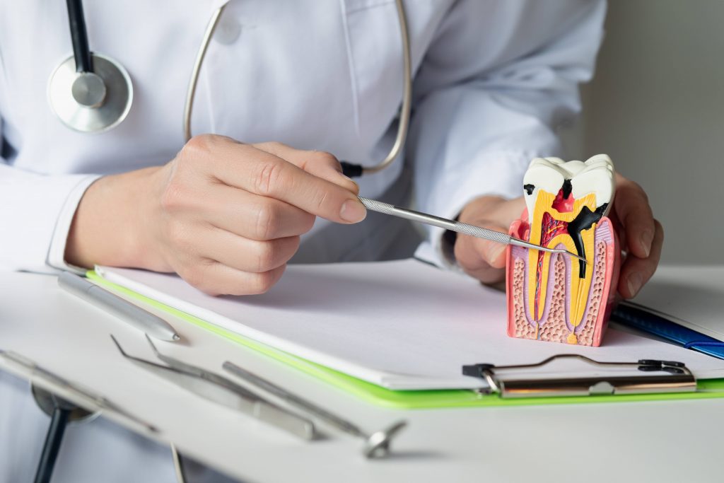 Endodontics Services | Root Canal Treatment | Metro Dental Clinic